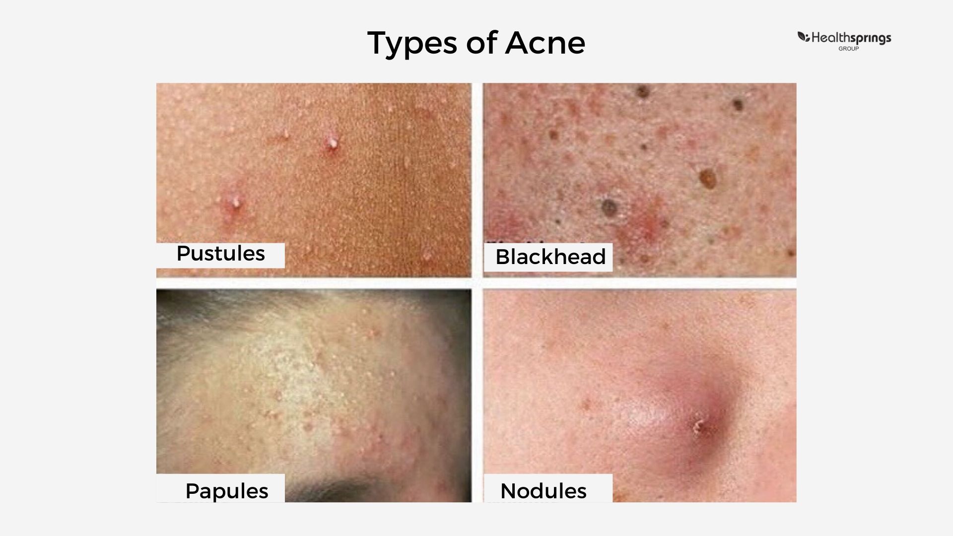 Aesthetic Treatments in Phase 1: Acne, Pigmentation, Warts Treatment ...
