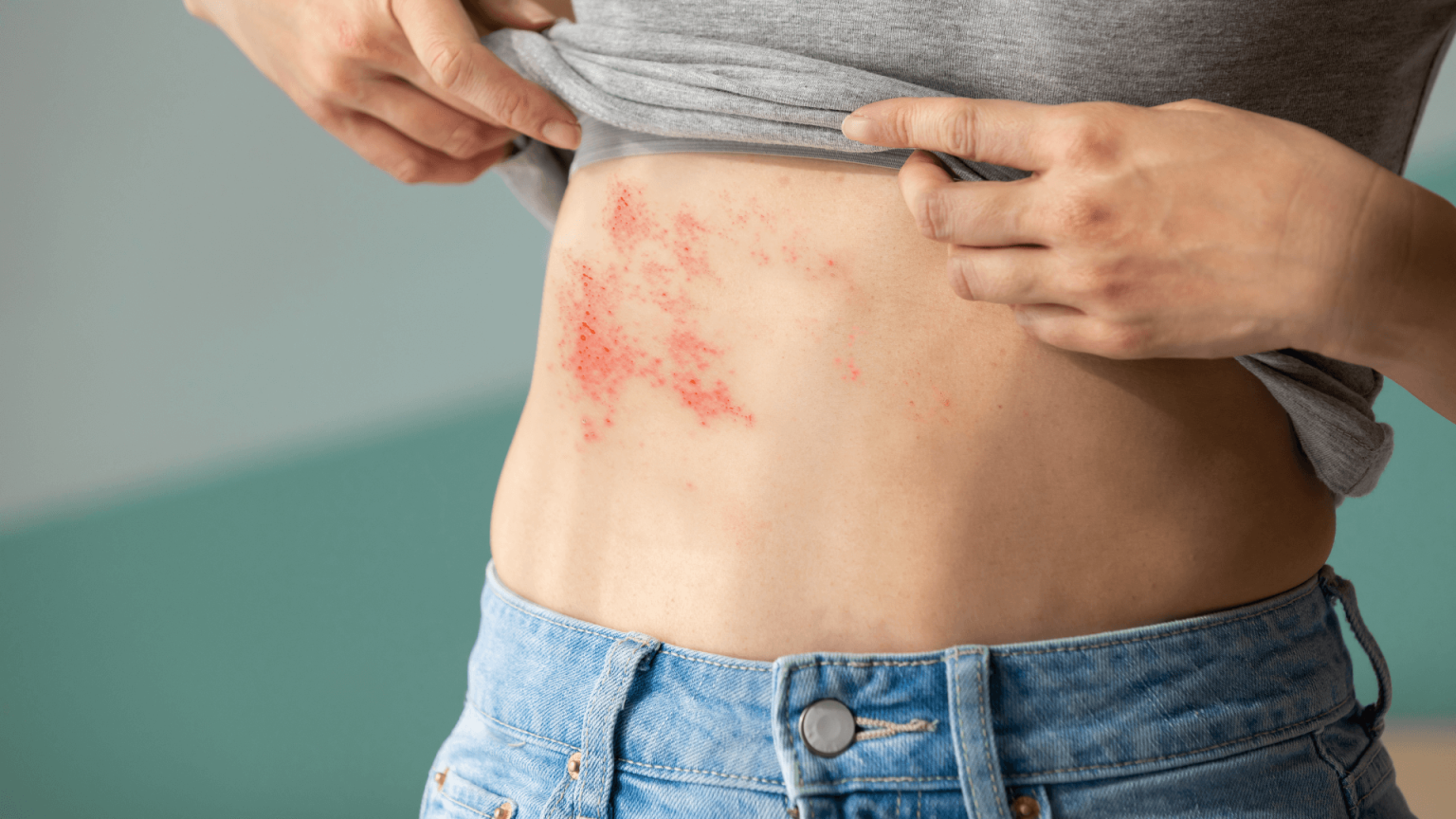 Shingles – Healthsprings